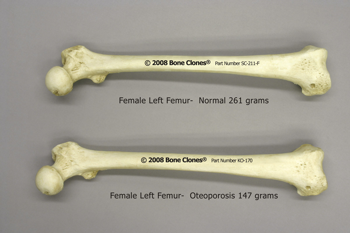 Human Adult Female Femur, Osteoporosis - Bone Clones, Inc ...