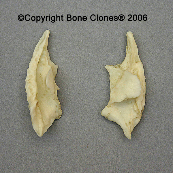 Lacrimal Bone Disarticulated