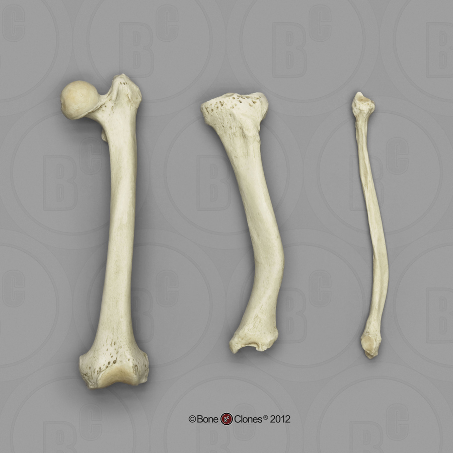 Human Femur, Tibia and Fibula, Rickets - Bone Clones, Inc ...